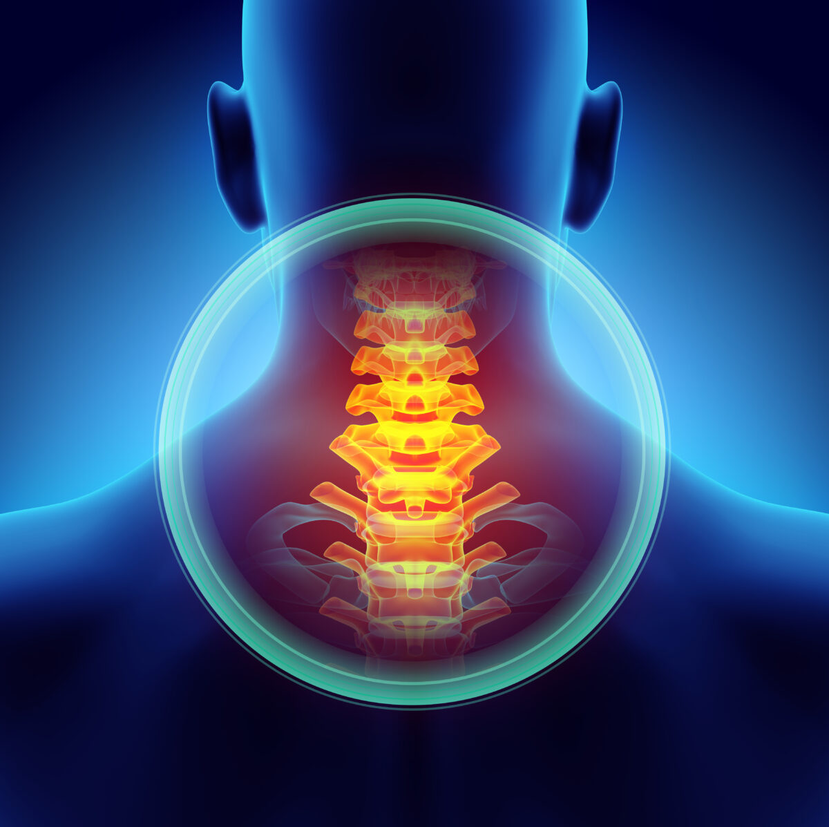 Cervical Transforaminal Epidural Steroid Injection - Physicians Pain ...